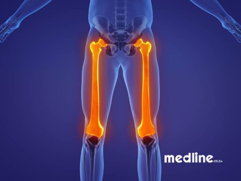 Osteomyelitis (Bone Infection) Causes, Symptoms, Treatment - Medline